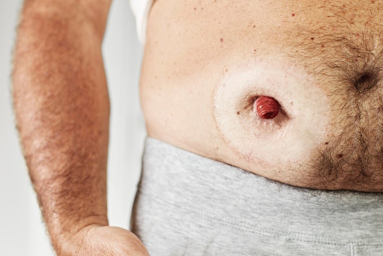 stoma skin problems